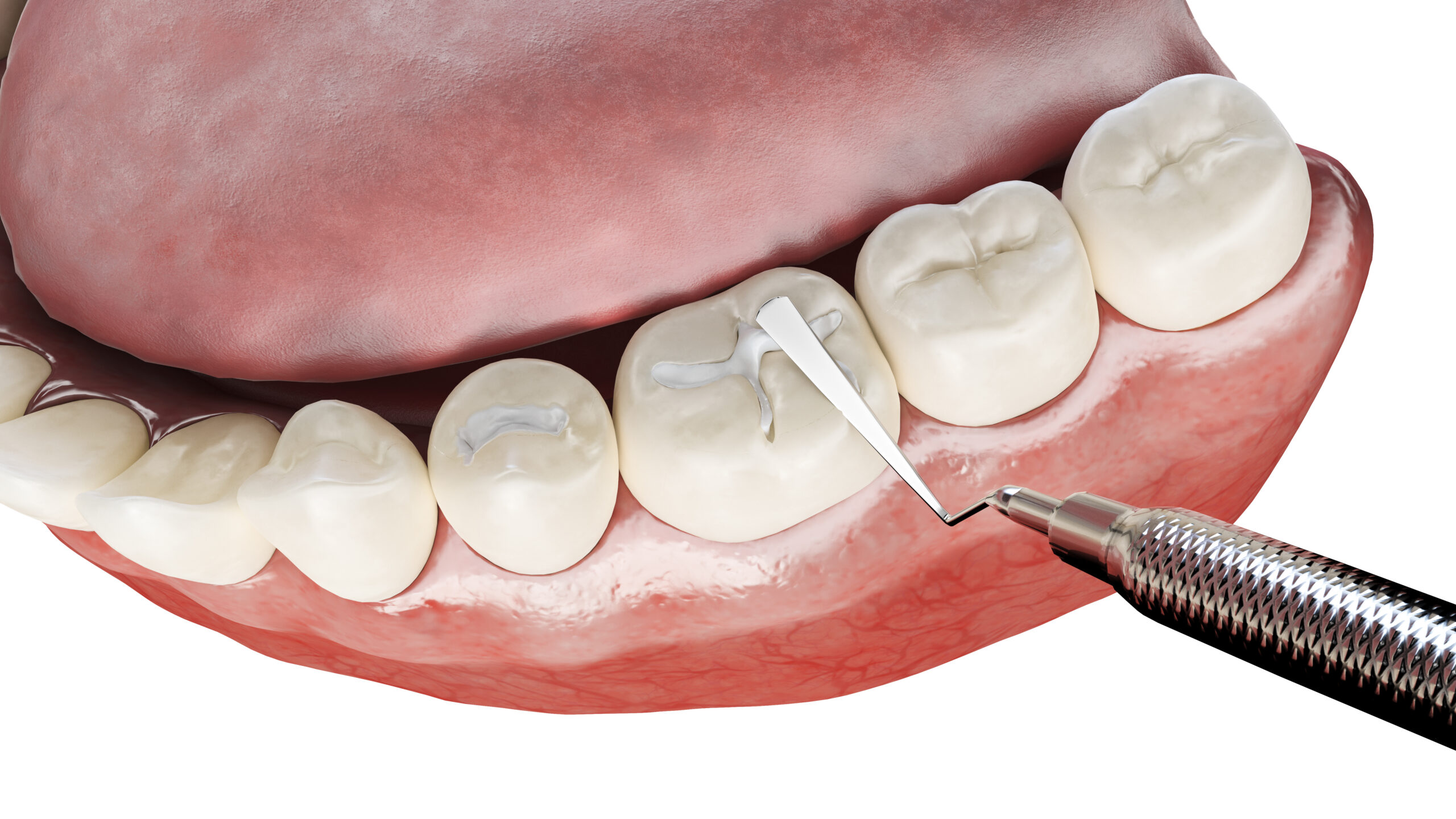 Restoring Your Tooth With Composite Resin | Ankeny, IA