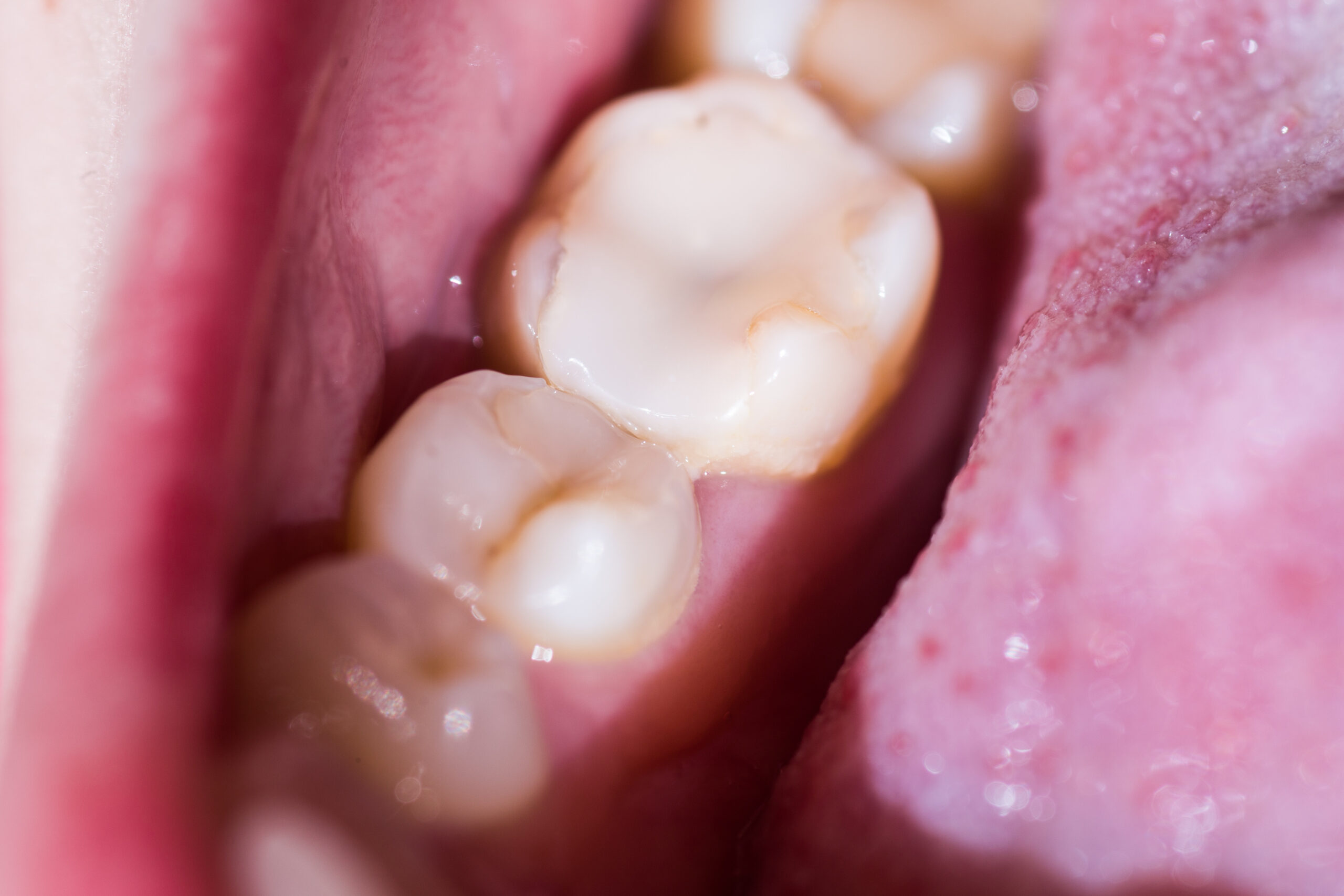 How Lifelike Fillings Treat Cavities | Ankeny, IA