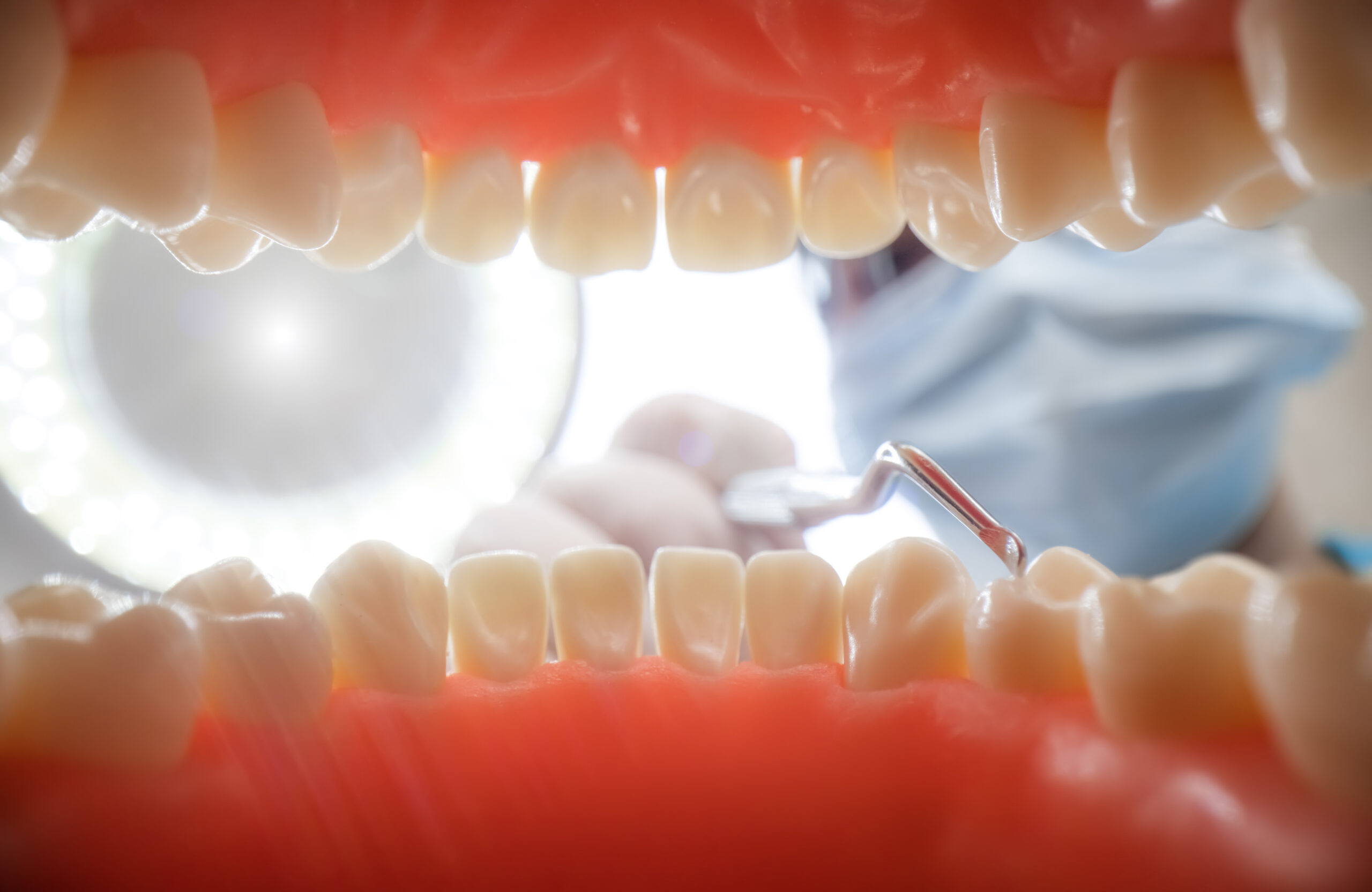 Mitigating Infection With Dental Fillings | Ankeny, IA