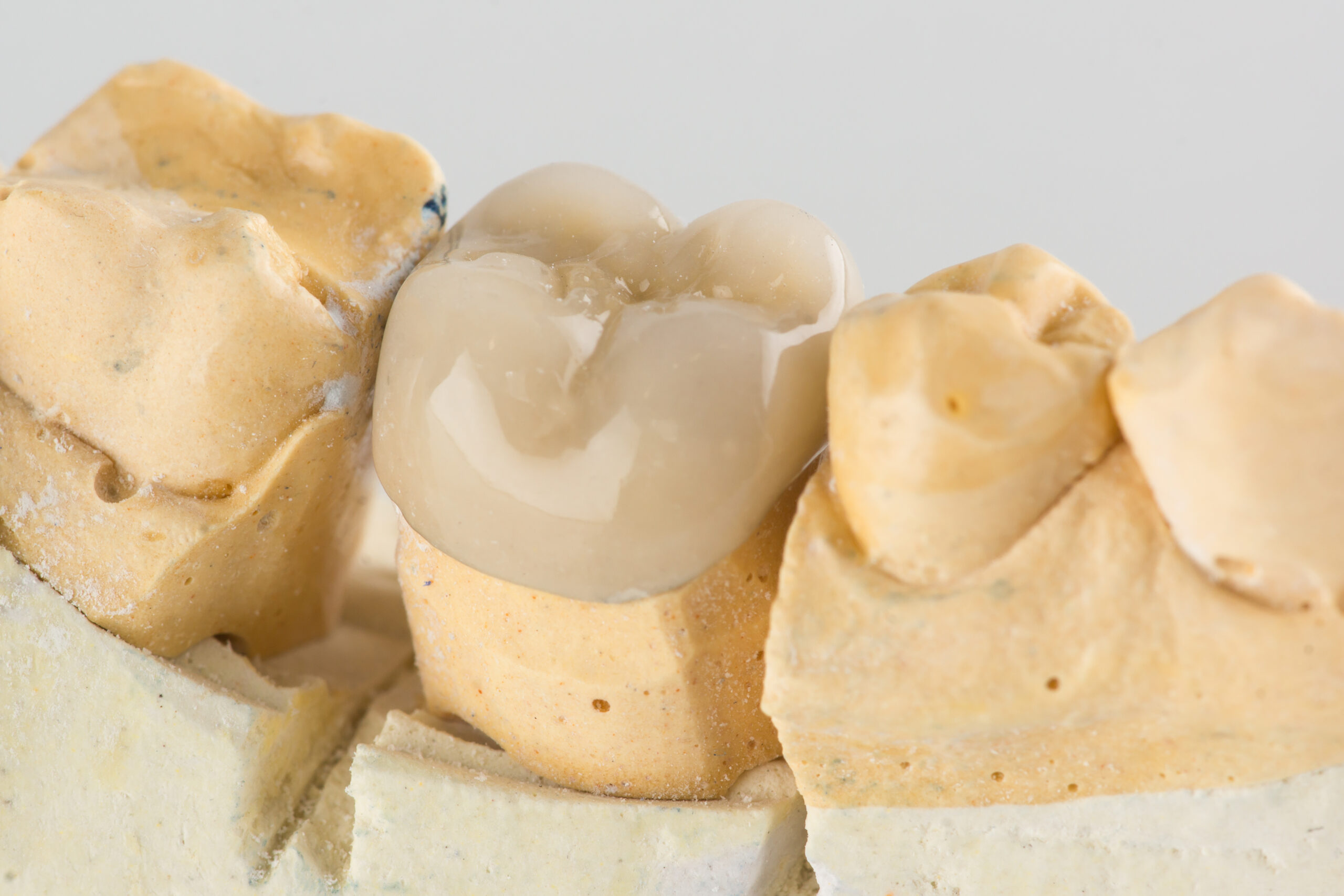 Restoring Smiles With Our Lifelike Crowns | Ankeny, IA