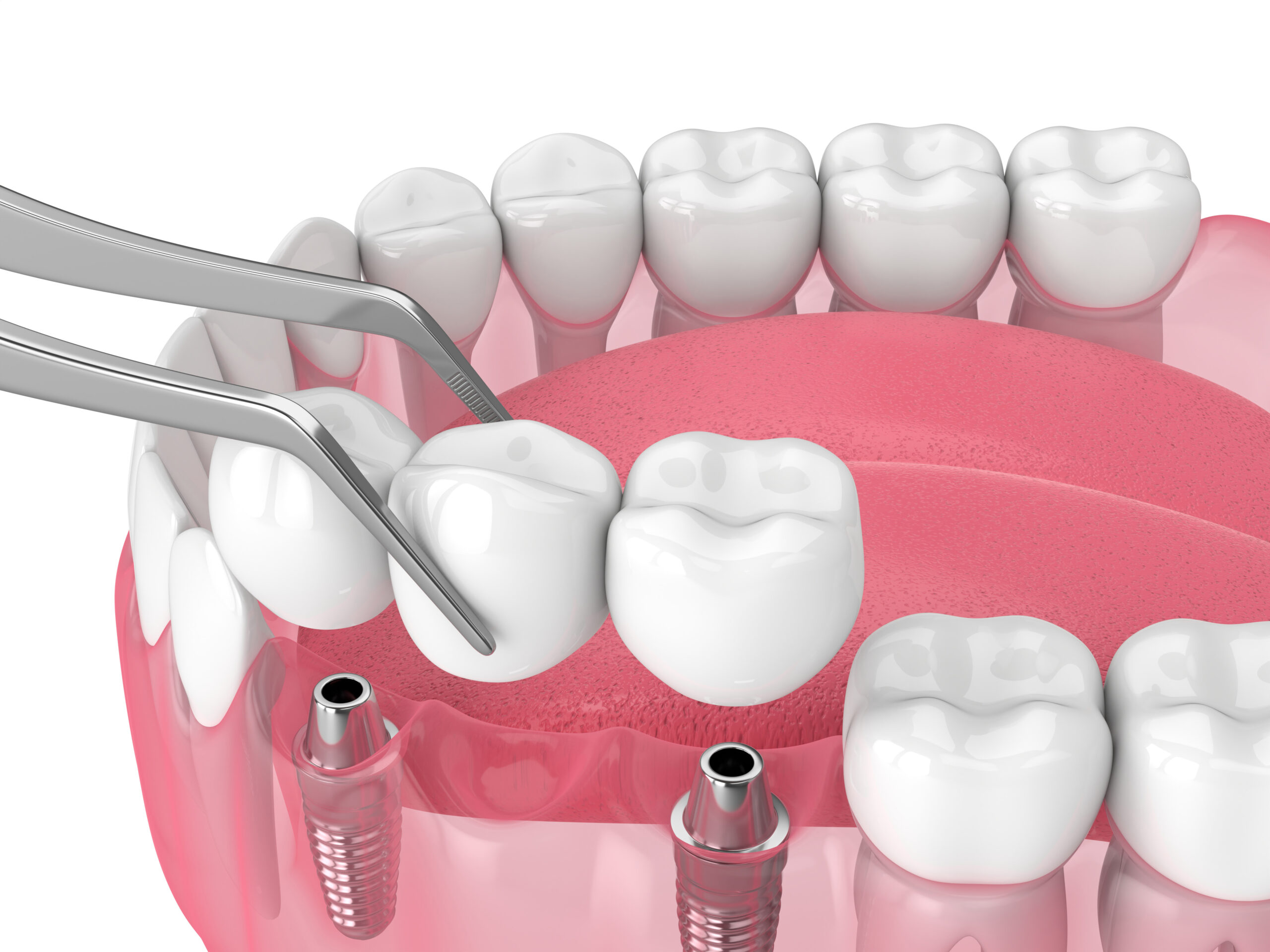 Traditional Vs. Implant Bridges | Ankeny, IA