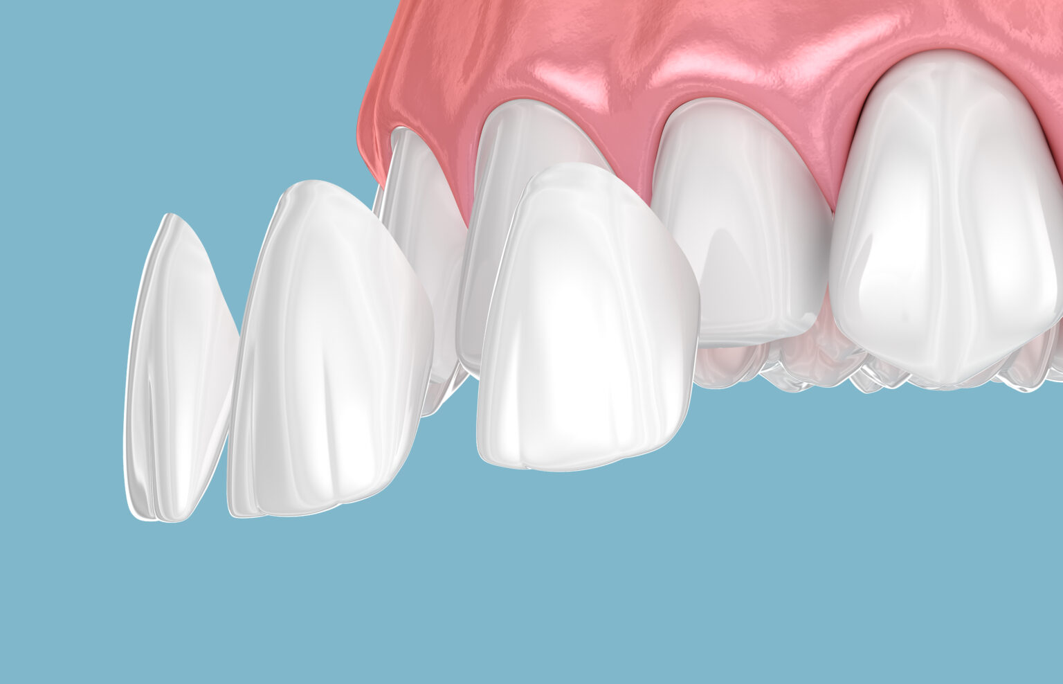 A Simple Smile Makeover With Porcelain Veneers | Ankeny, IA
