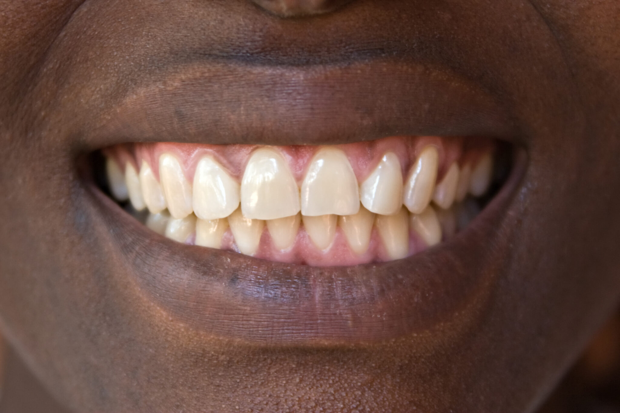 Good Gum Health Keeps Smiles Full | Ankeny, IA