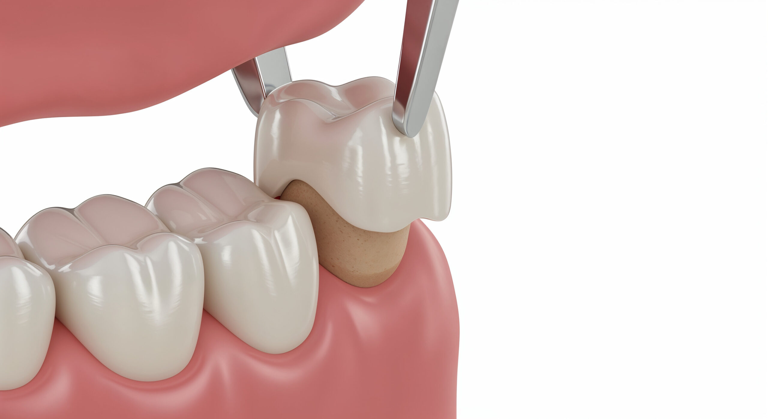 Placing Custom Crowns That Look Natural | Ankeny, IA