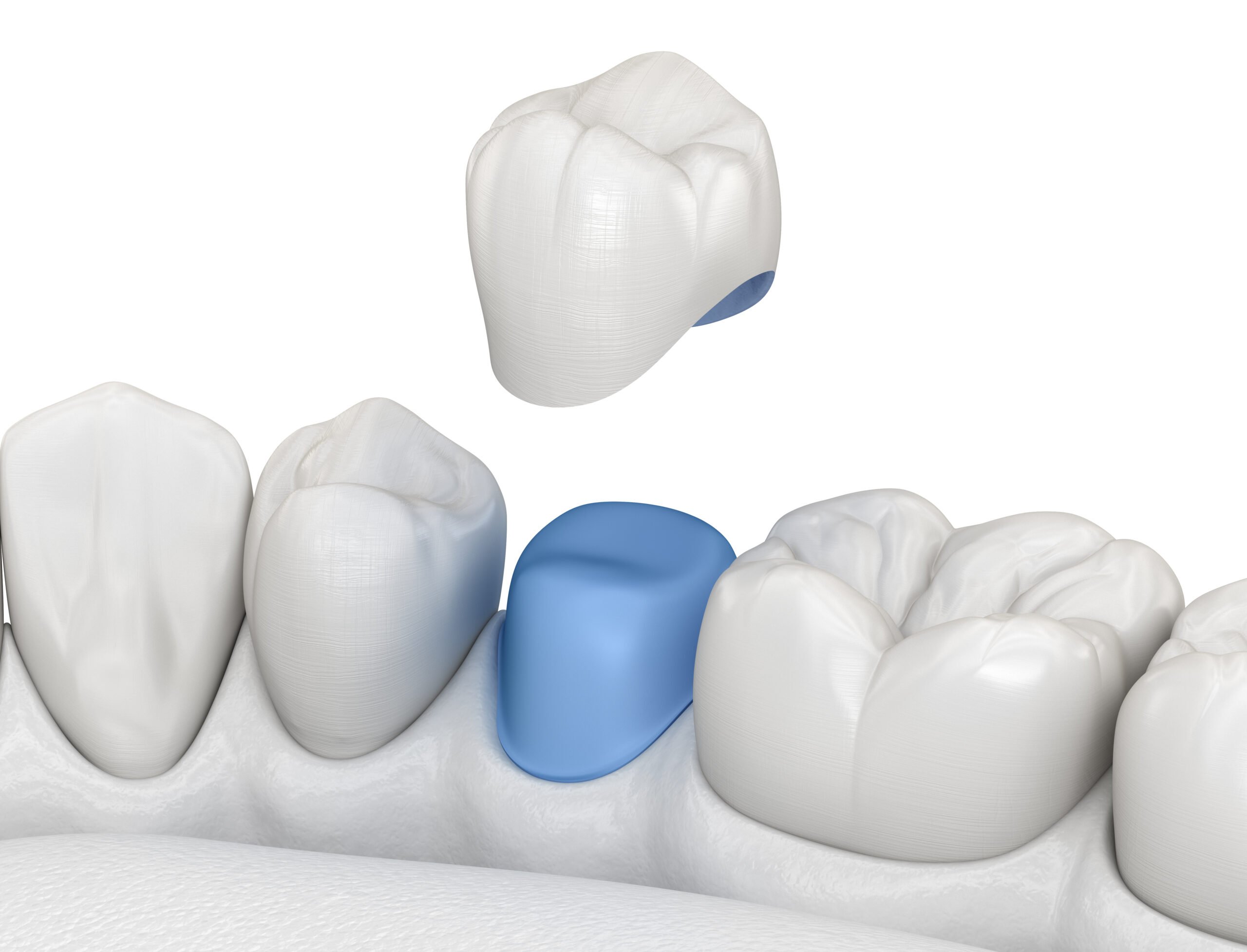 Fixing Teeth With Porcelain Crowns | Ankeny, IA