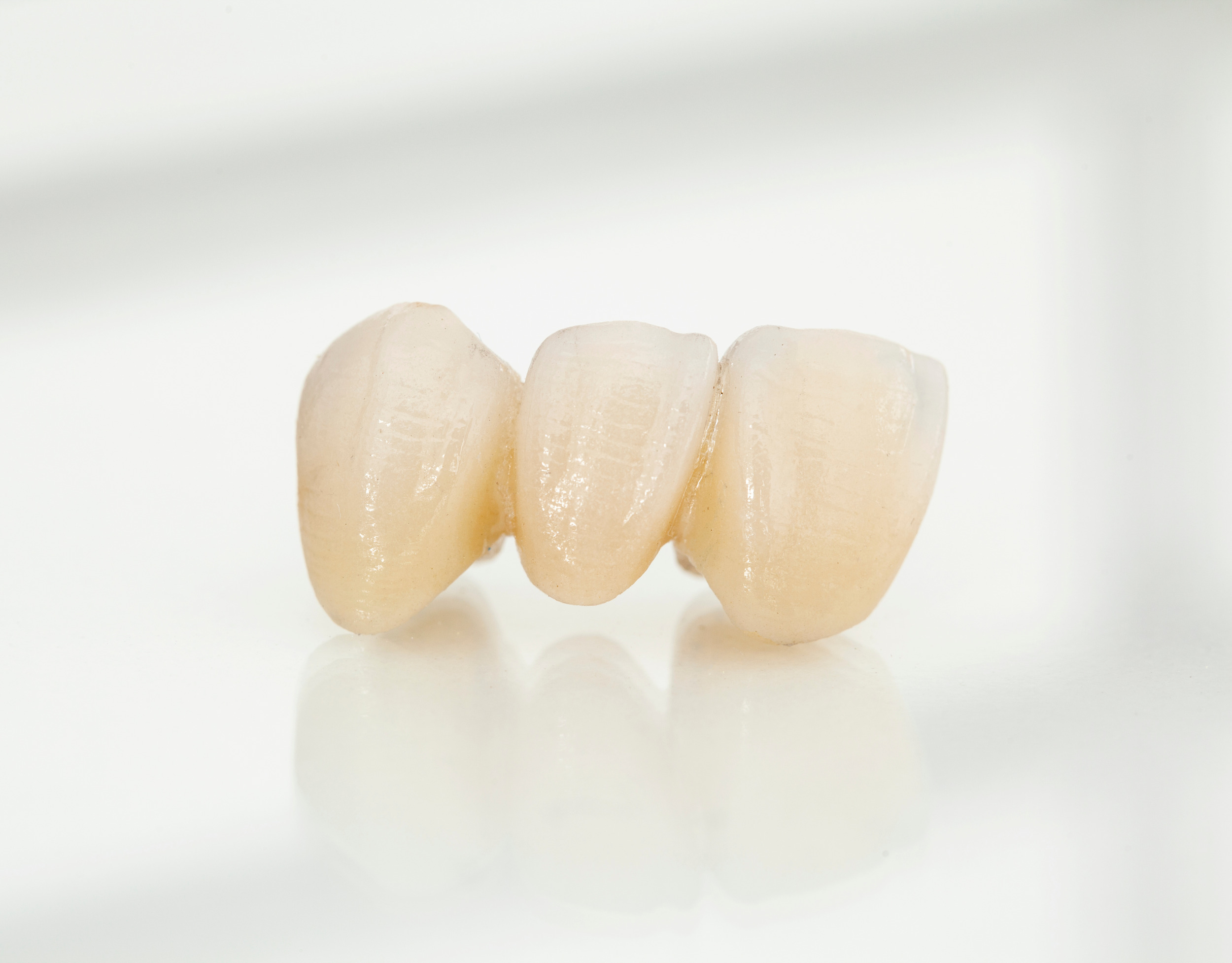 Bridges Help Fill The Gaps Caused By Tooth Loss | Ankeny, IA