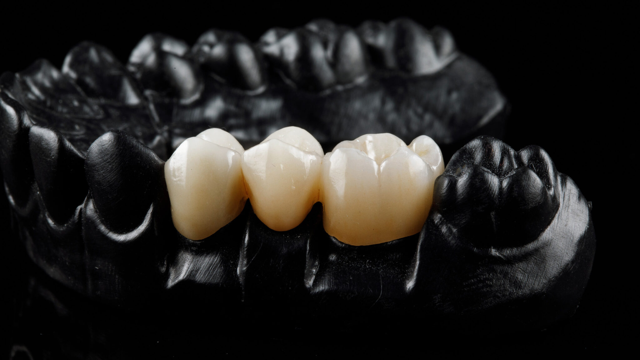 Creating Bridges For Your Missing Teeth | Ankeny, IA