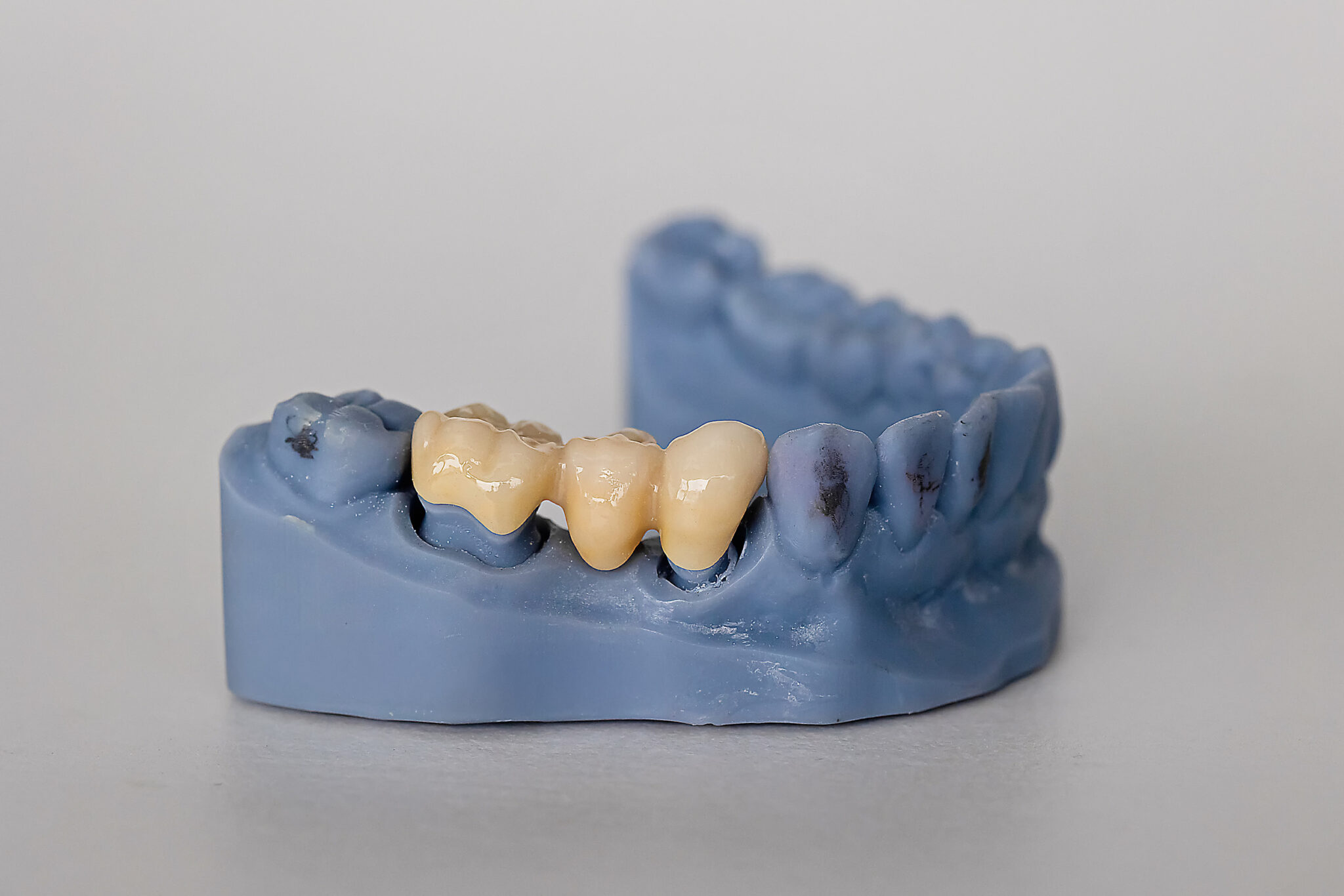 Placing A Bridge To Address A Lost Tooth | Ankeny, IA